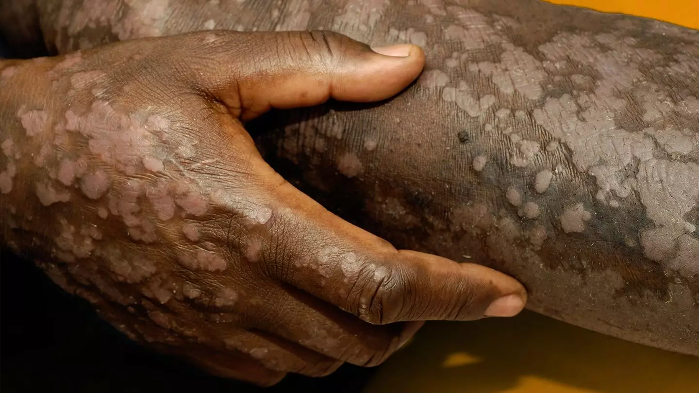 peau noire afro-américaine atteinte de psoriasis