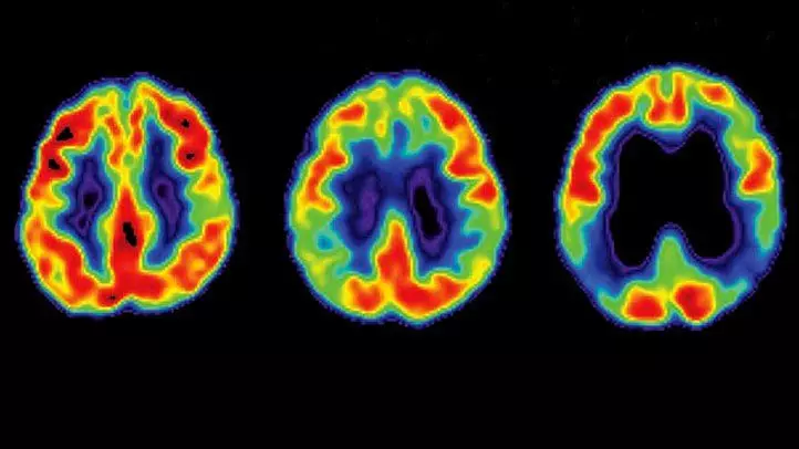 scansioni cerebrali che mostrano la progressione della malattia di Alzheimer