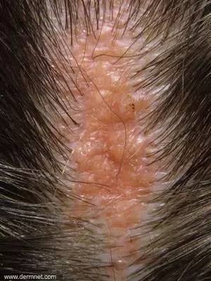 sebaceous nevus