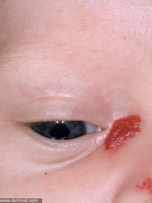 strawberry hemangioma akara ọmụmụ