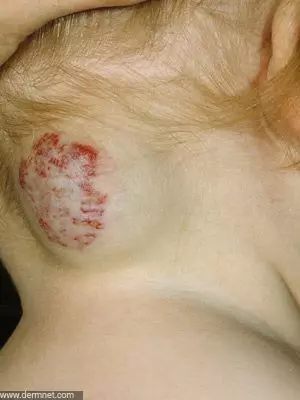 cavernous hemangioma akara ọmụmụ