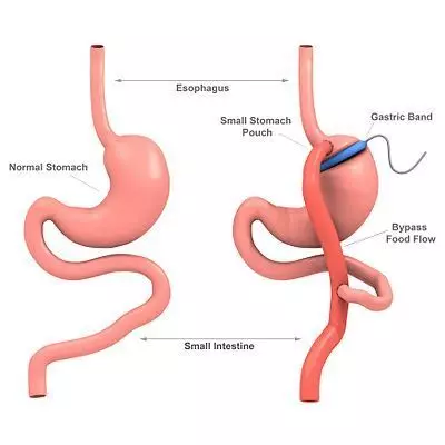 Dva za jednog Prednost gastrične premosnice