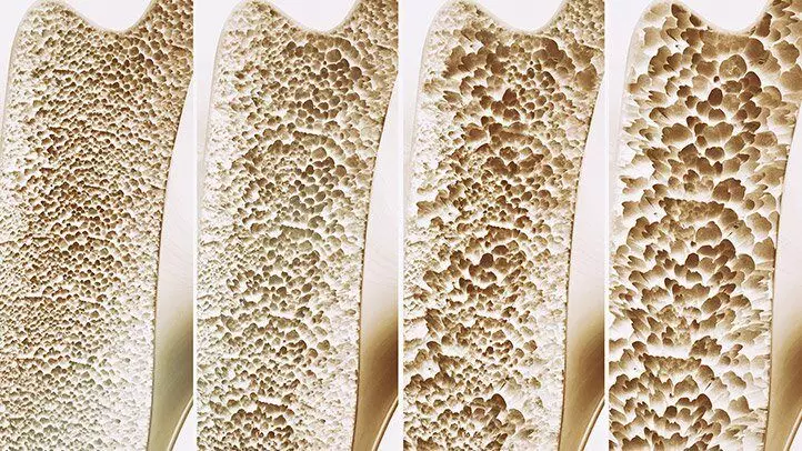 een voorbeeld van osteoporose in de botten