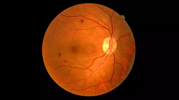 Pagsabot sa Diabetic Macular Edema